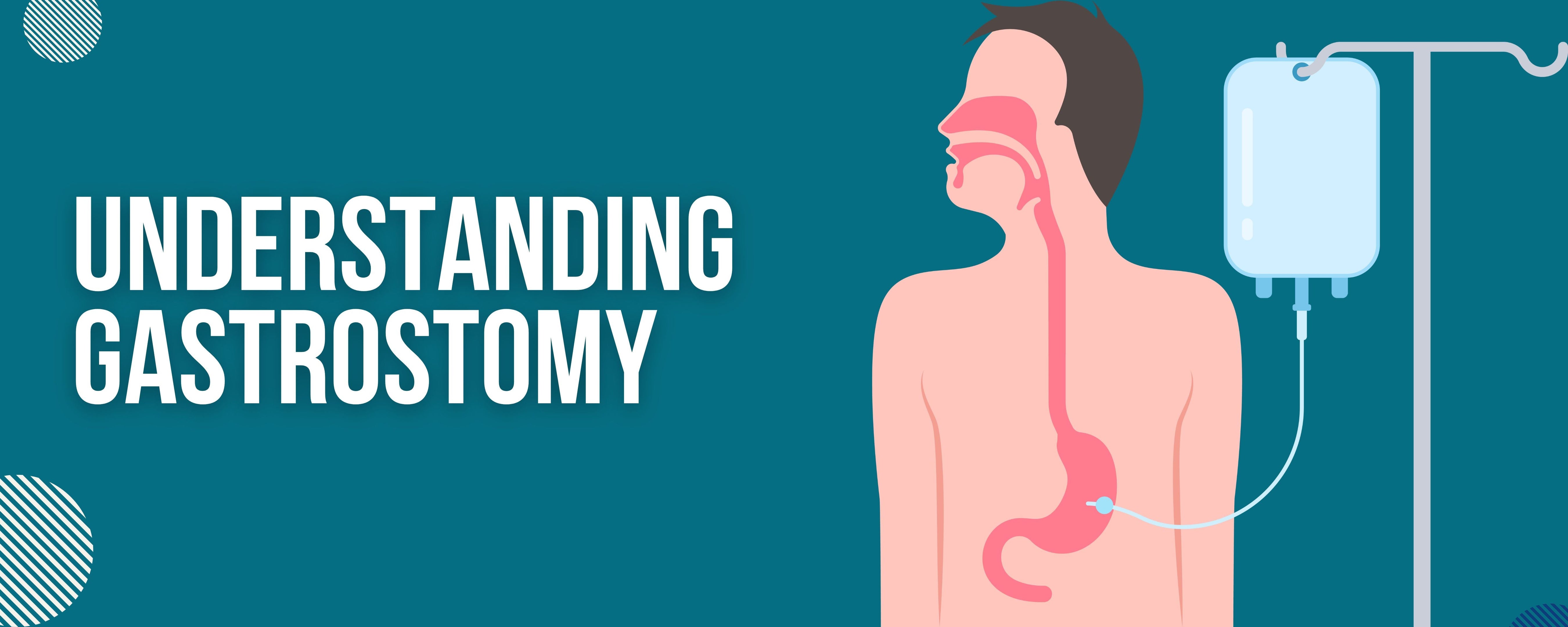 Understanding Gastrostomy: Definition and Purpose — Medical Supply Pros